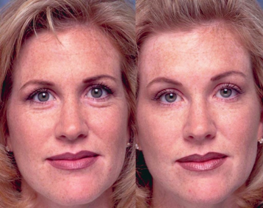 Microdroplet Lift Beverly Hills | Botox Brow Lift