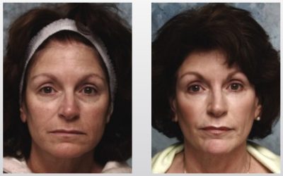 Microdroplet Lift Beverly Hills | Botox Brow Lift